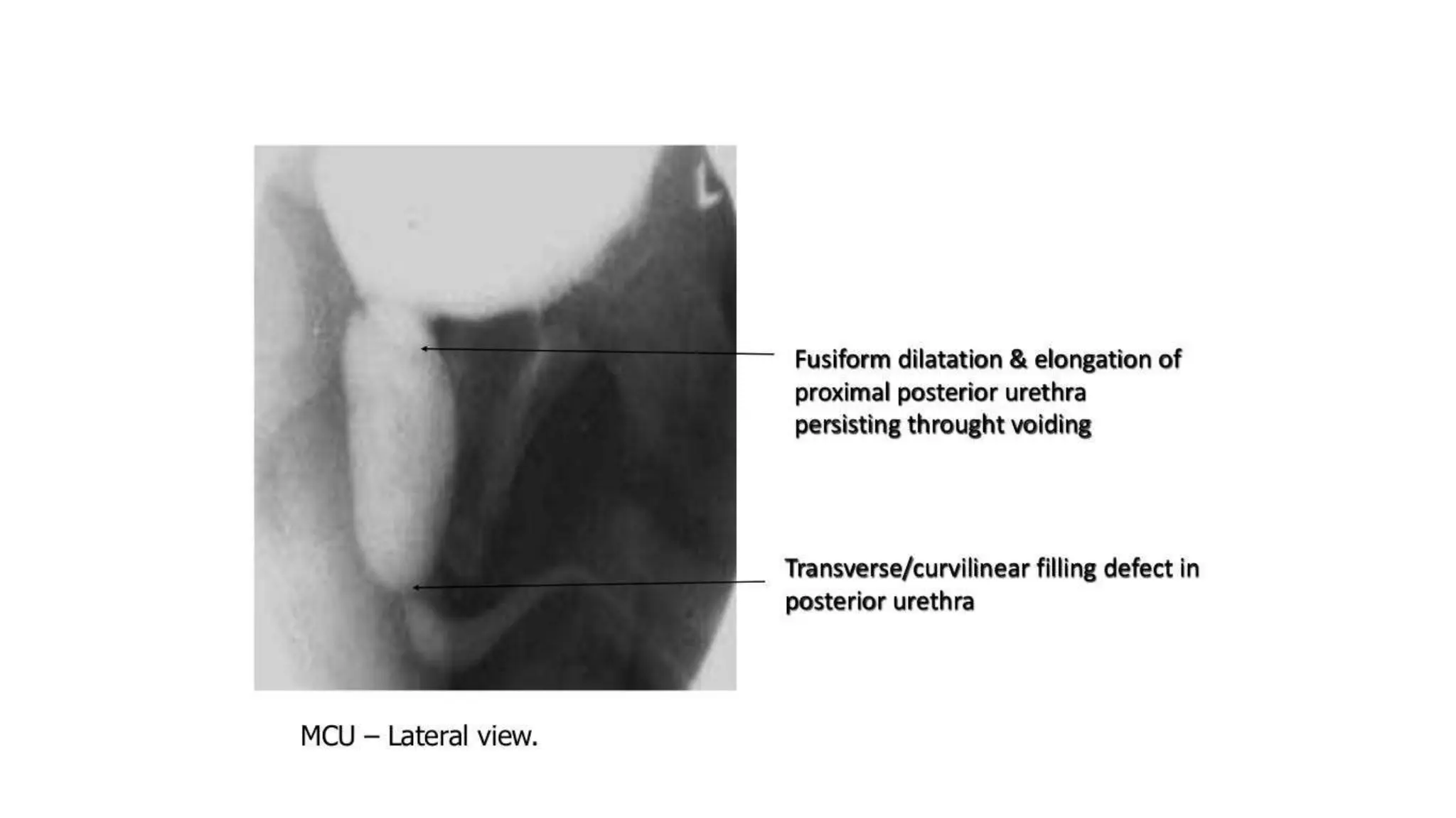 MCU and AUG - CYSTOURETHEROGRAM Urology.pptx