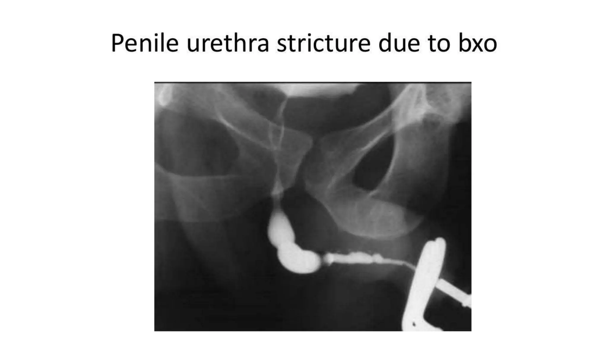 MCU and AUG - CYSTOURETHEROGRAM Urology.pptx