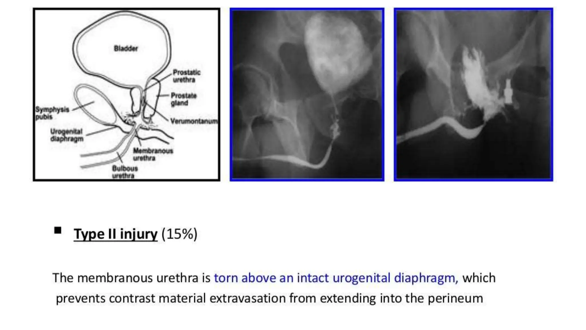 MCU and AUG - CYSTOURETHEROGRAM Urology.pptx