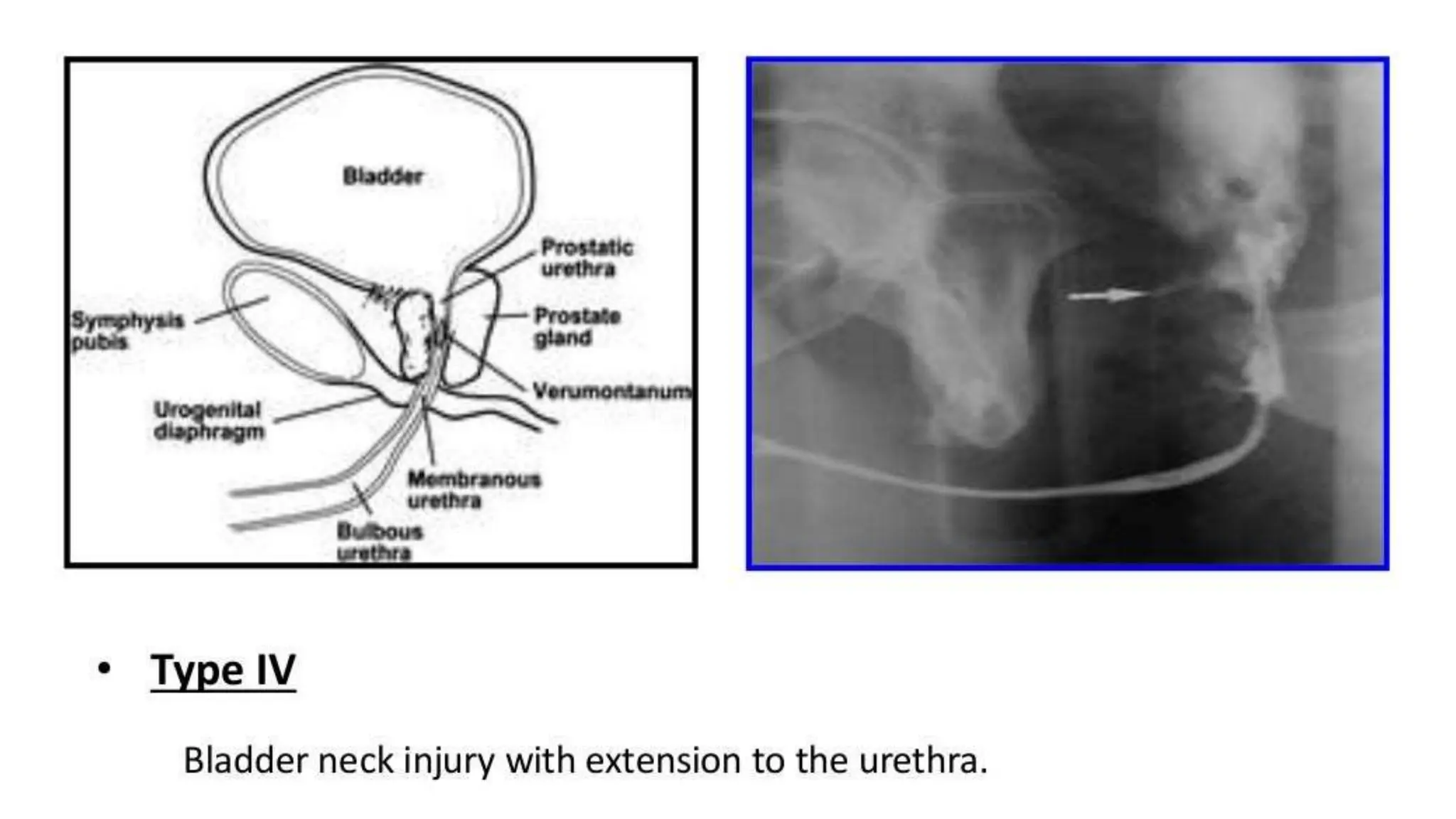 MCU and AUG - CYSTOURETHEROGRAM Urology.pptx