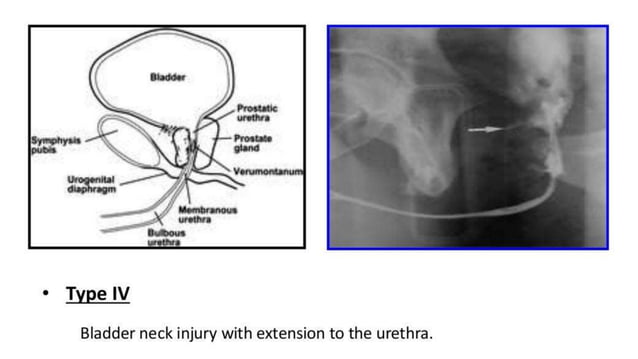 MCU and AUG - CYSTOURETHEROGRAM Urology.pptx