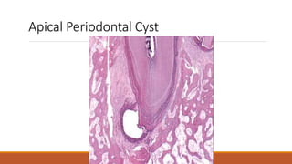 Cysts | PPTX