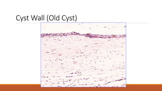 Cysts | PPTX