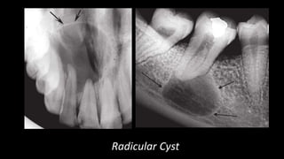 Cysts | PPSX