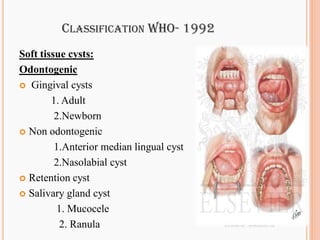 Cysts of jaw | PDF