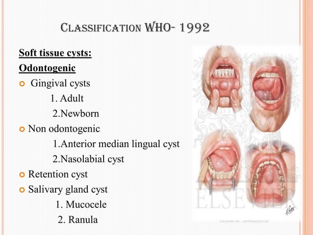 Cysts of jaw | PDF | Dental Health | Diseases and Conditions