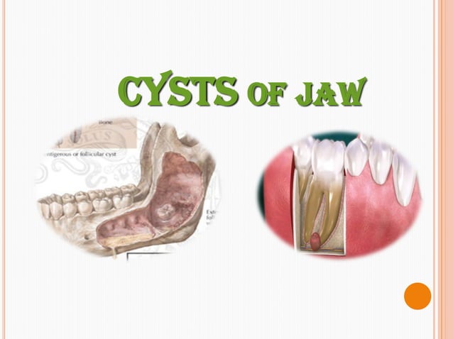 Cysts of jaw | PDF | Dental Health | Diseases and Conditions