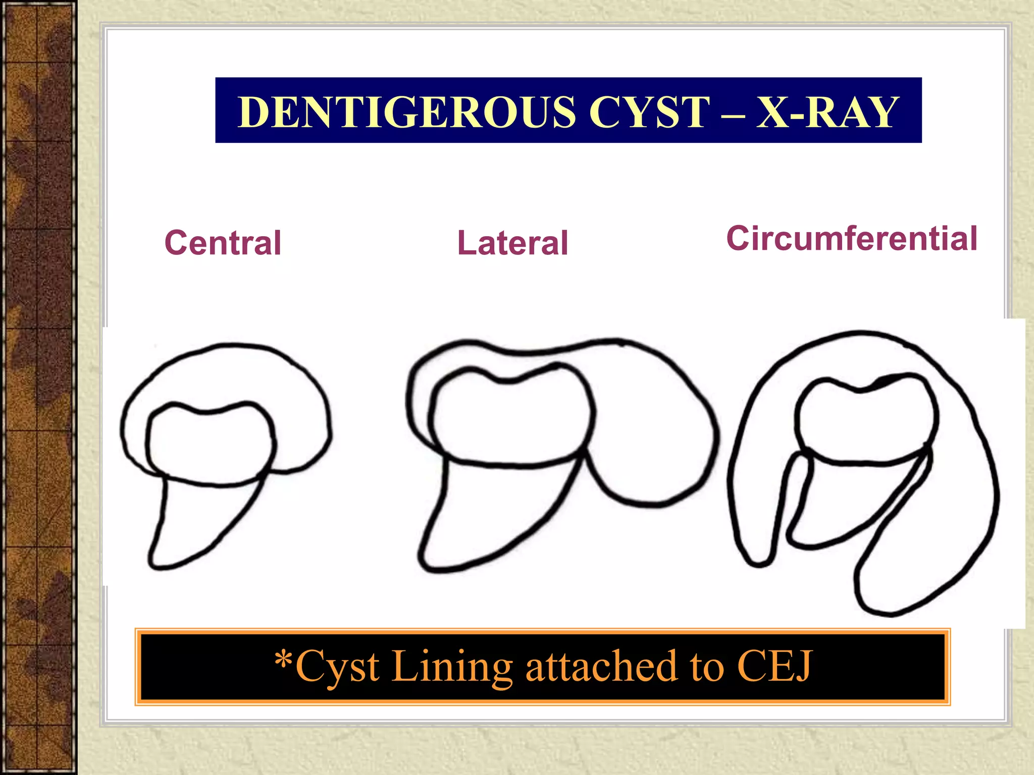 Cysts.ppt