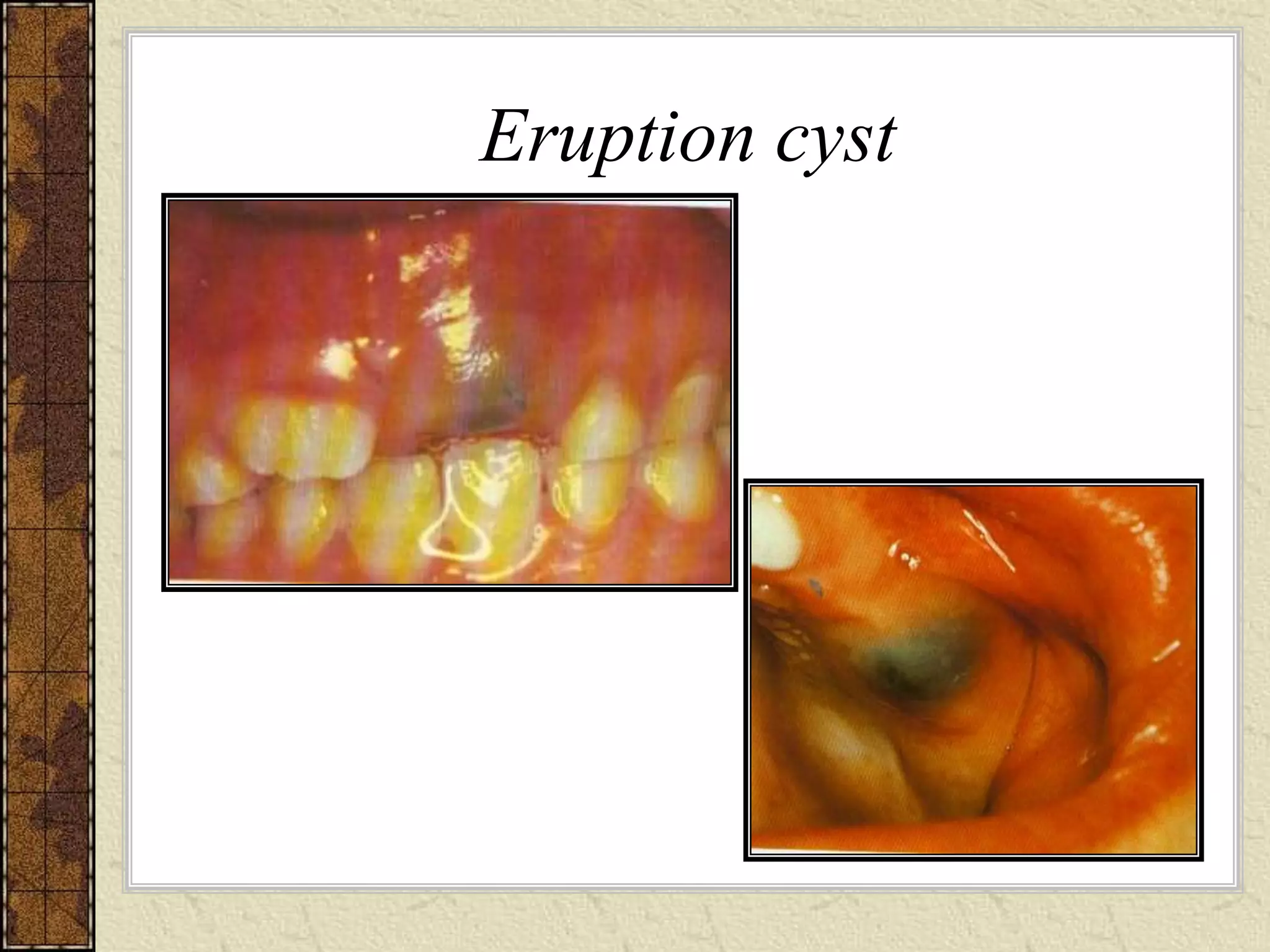 Cysts.ppt