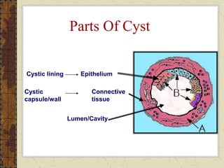 Cysts.ppt