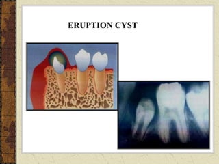 Cysts.ppt