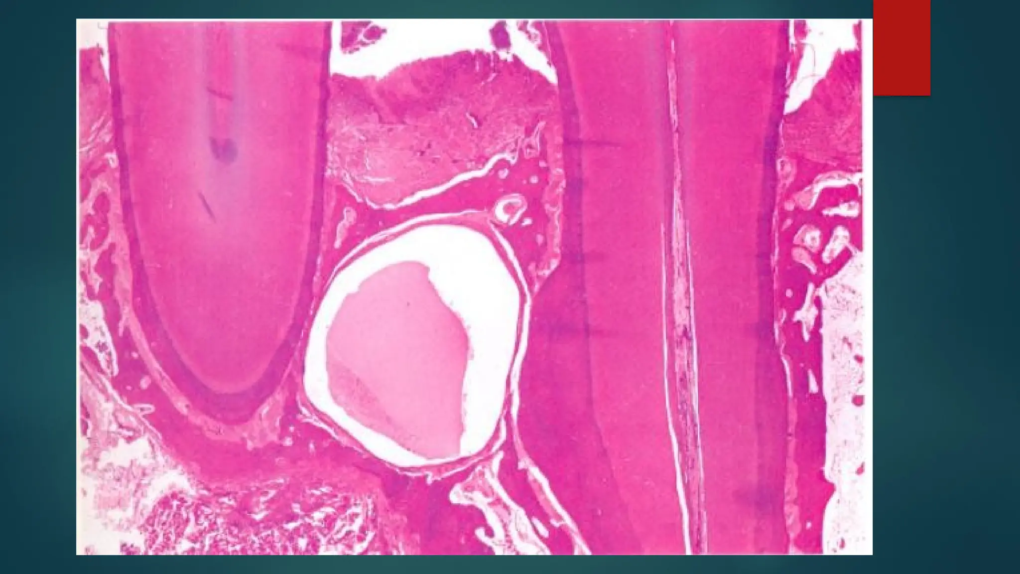 odontogenic cysts and tumors or oral cavity | PPTX