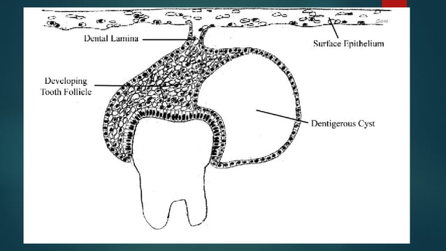 odontogenic cysts and tumors or oral cavity | PPTX
