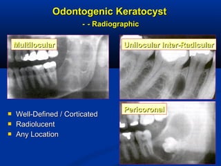 Odontogenic Keratocyst Radiology
