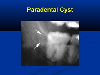 Paradental Cyst