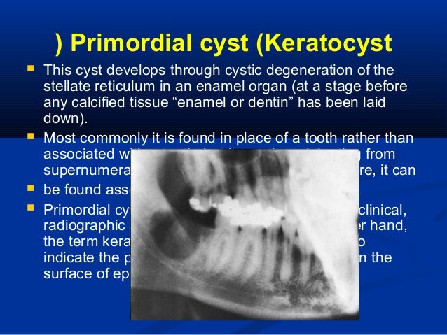 Odontogenic Cysts