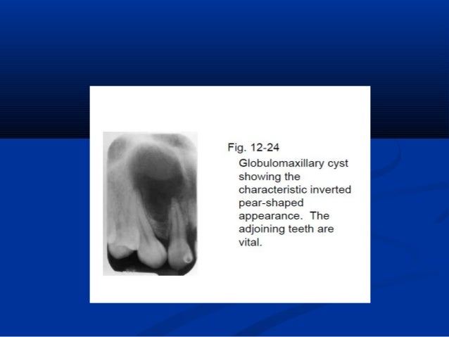 Globulomaxillary Cyst Radicular Cyst: Cause, Symptoms And Treatmen