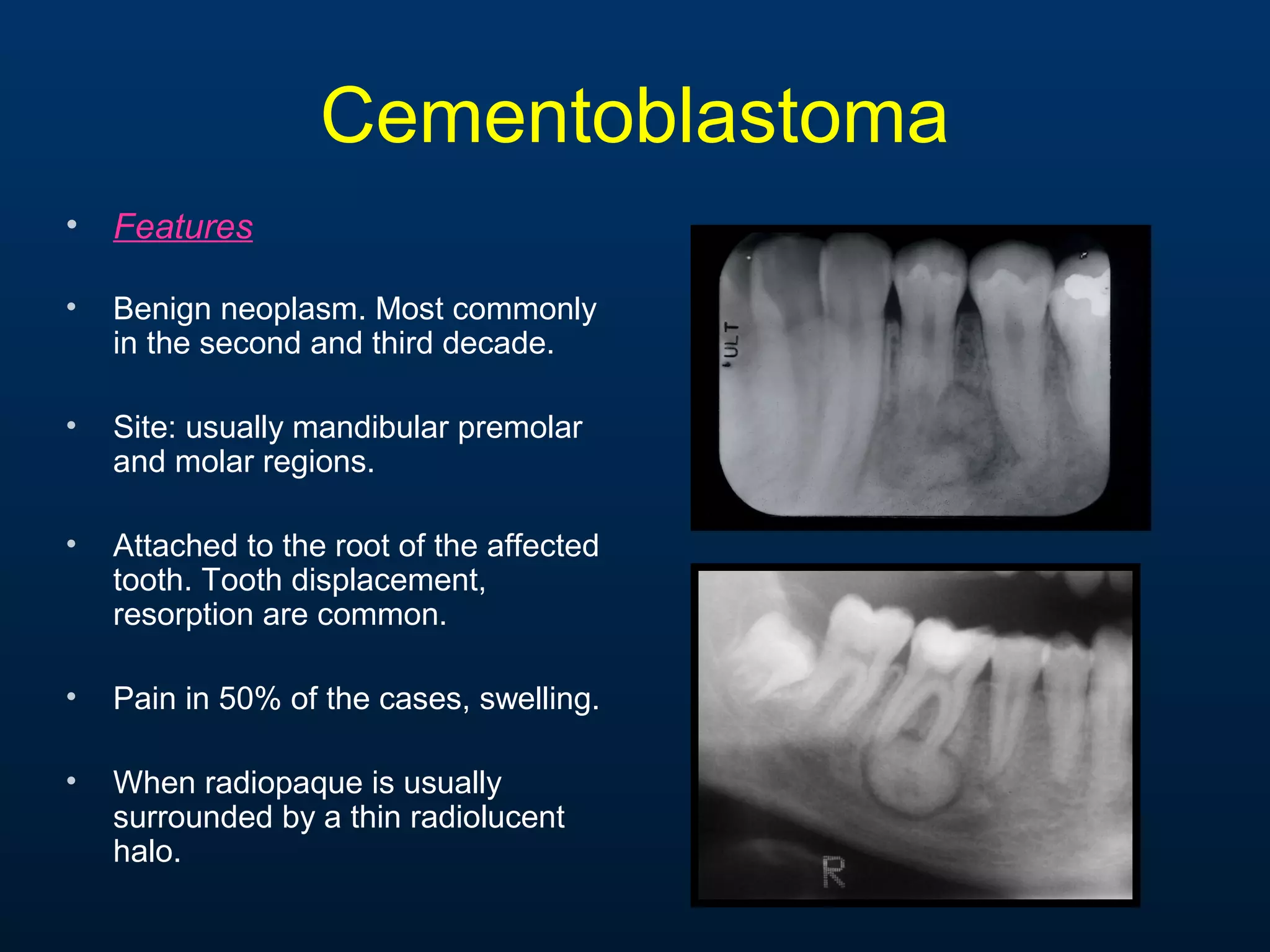 Cysts and Odontogenic tumors | PPT