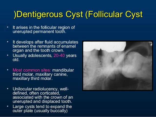 Follicular Cyst