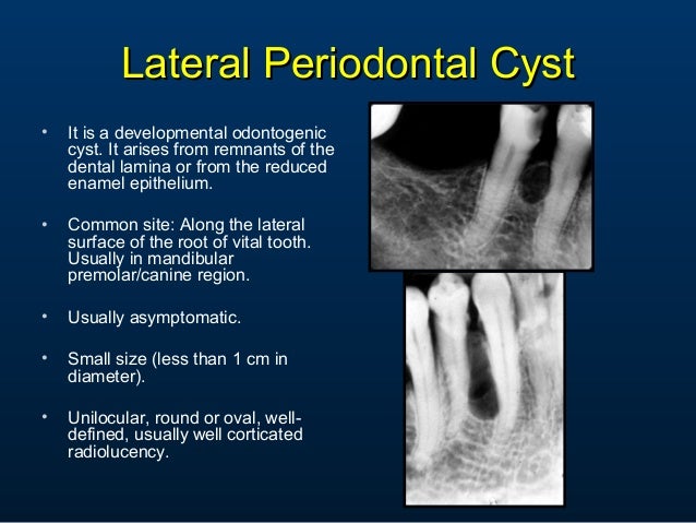 Cysts and Odontogenic tumors