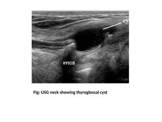 Cysts and sinus of neck in head and neck cancer..pptx