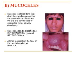 CYSTS AND TUMORS OF SALIVARY GLANDS.ppt