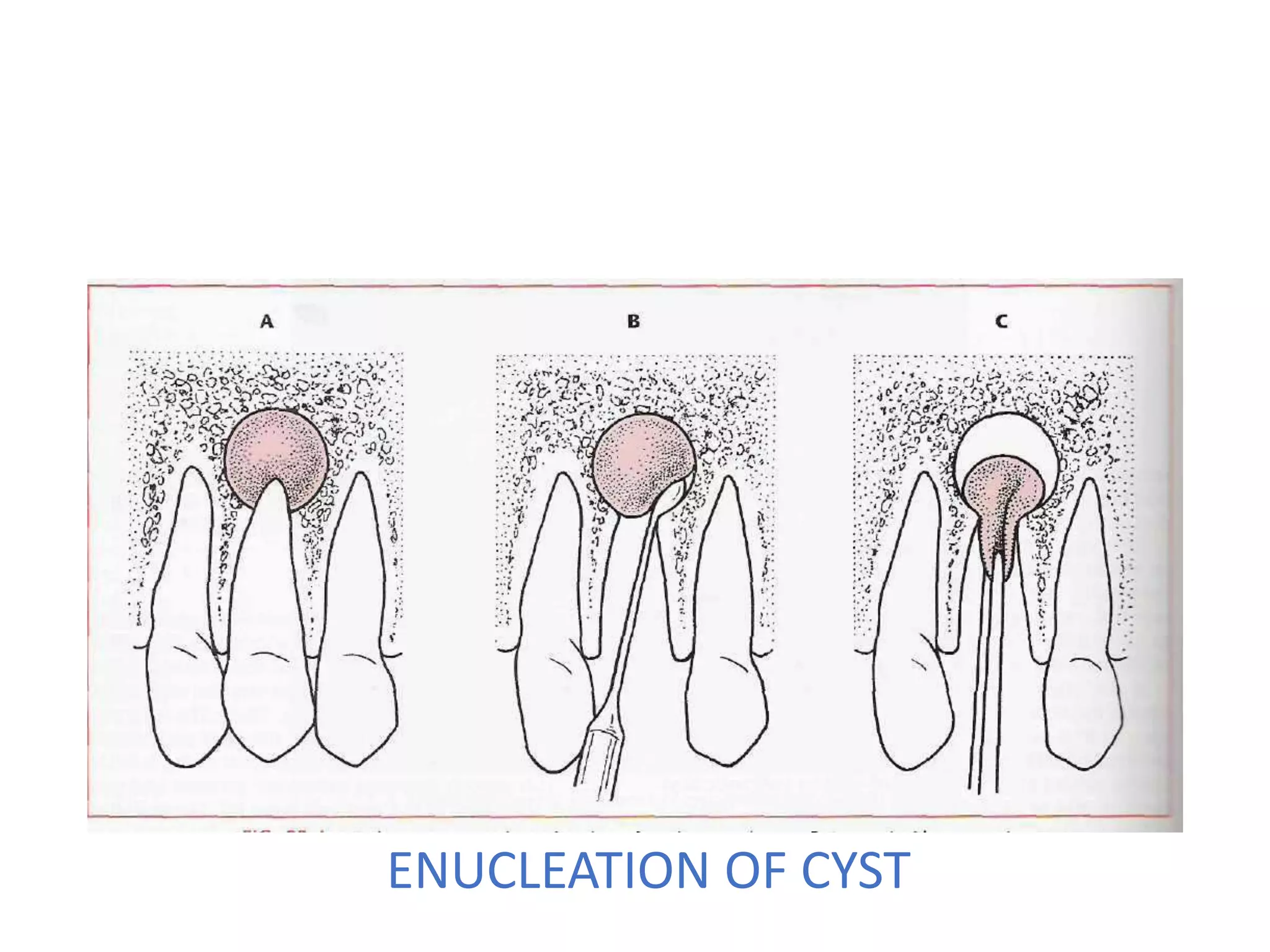Cysts in children | PPTX