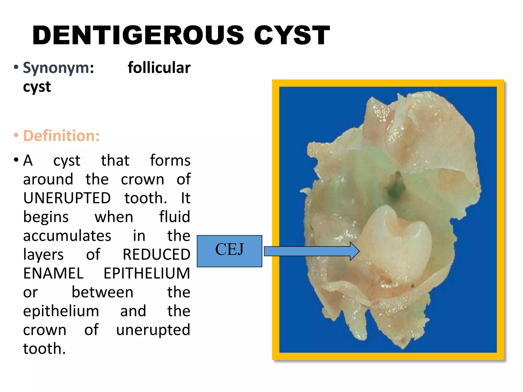 Cysts in children | PPTX
