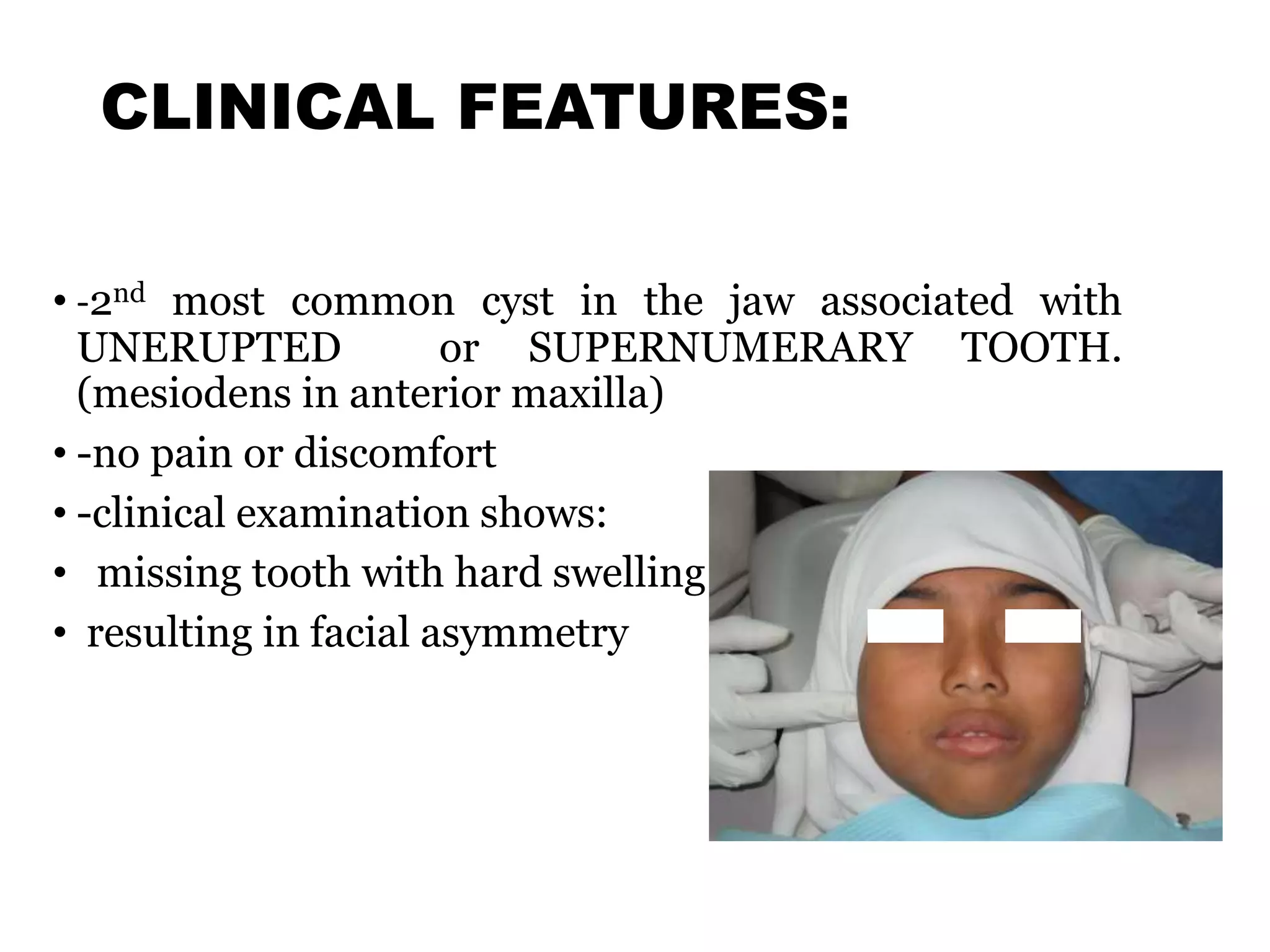 Cysts in children | PPTX