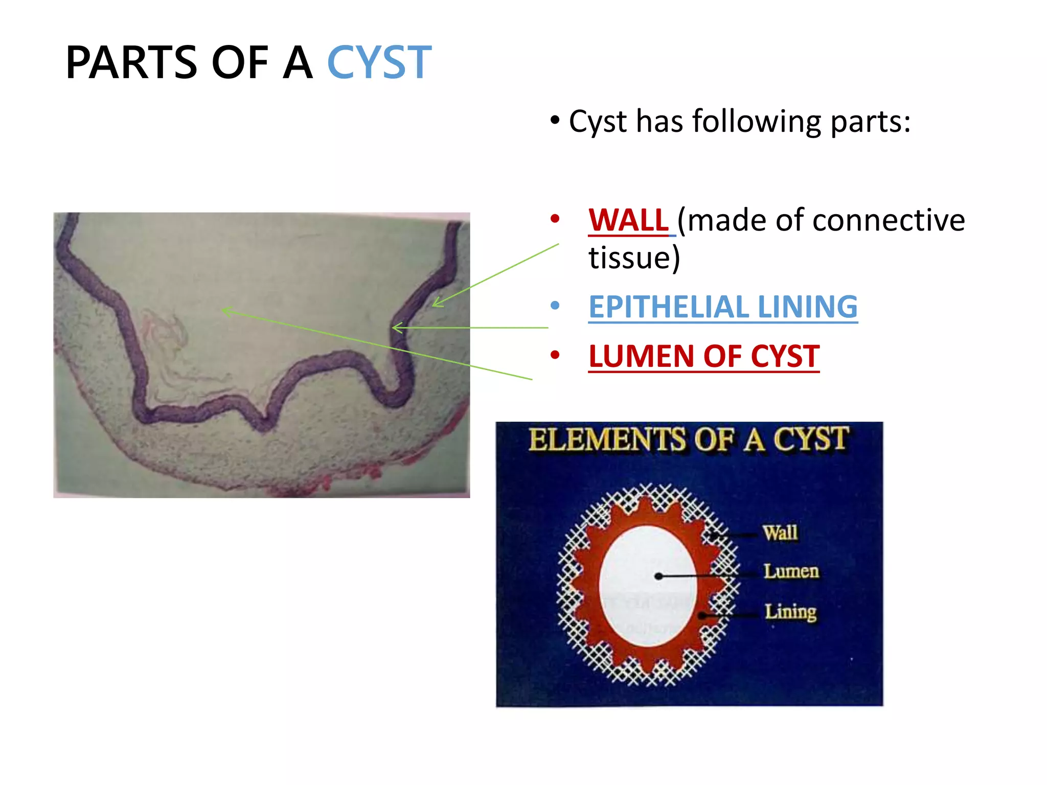Cysts in children | PPTX