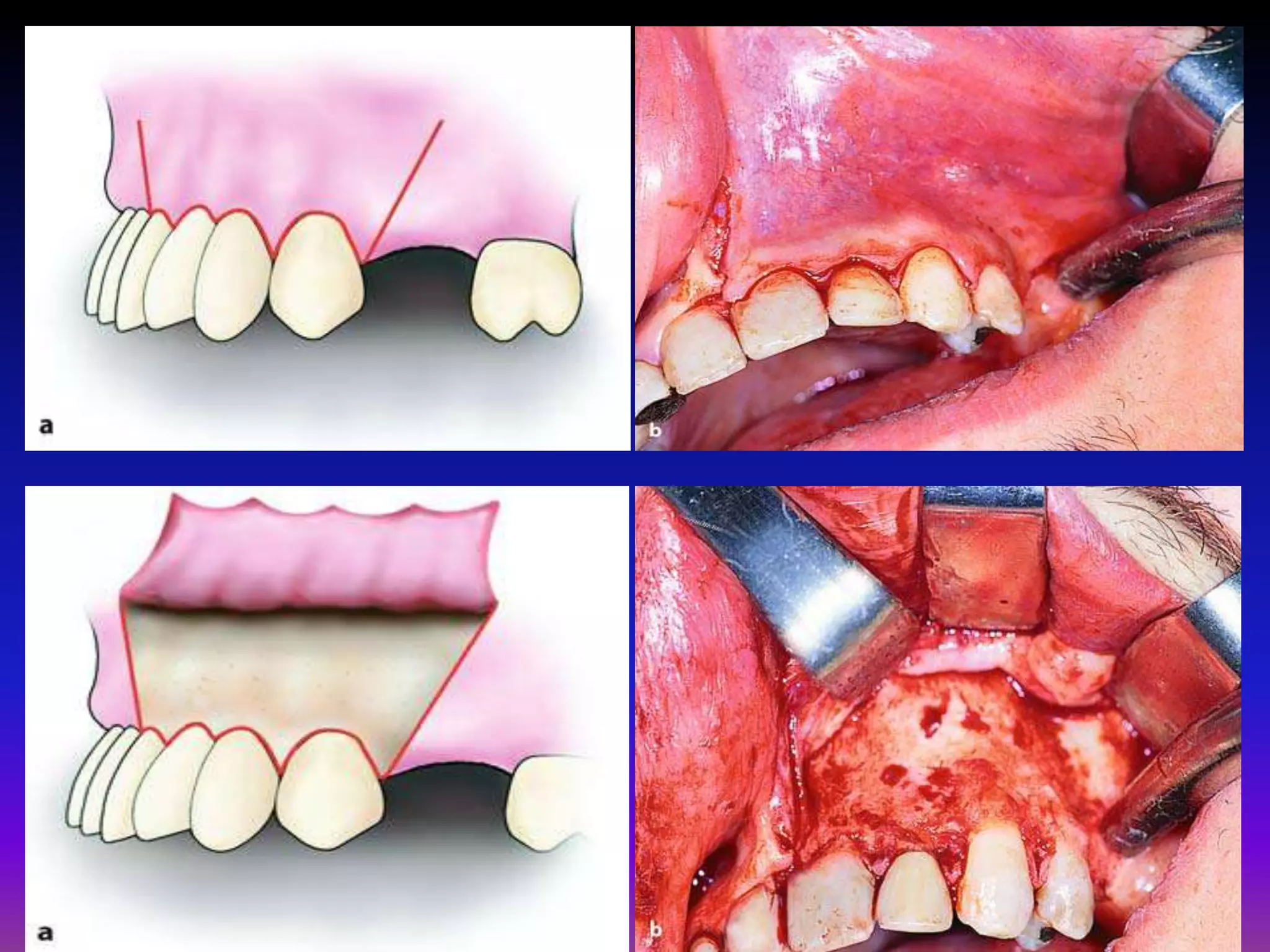 Cysts in orofacial region | PPSX