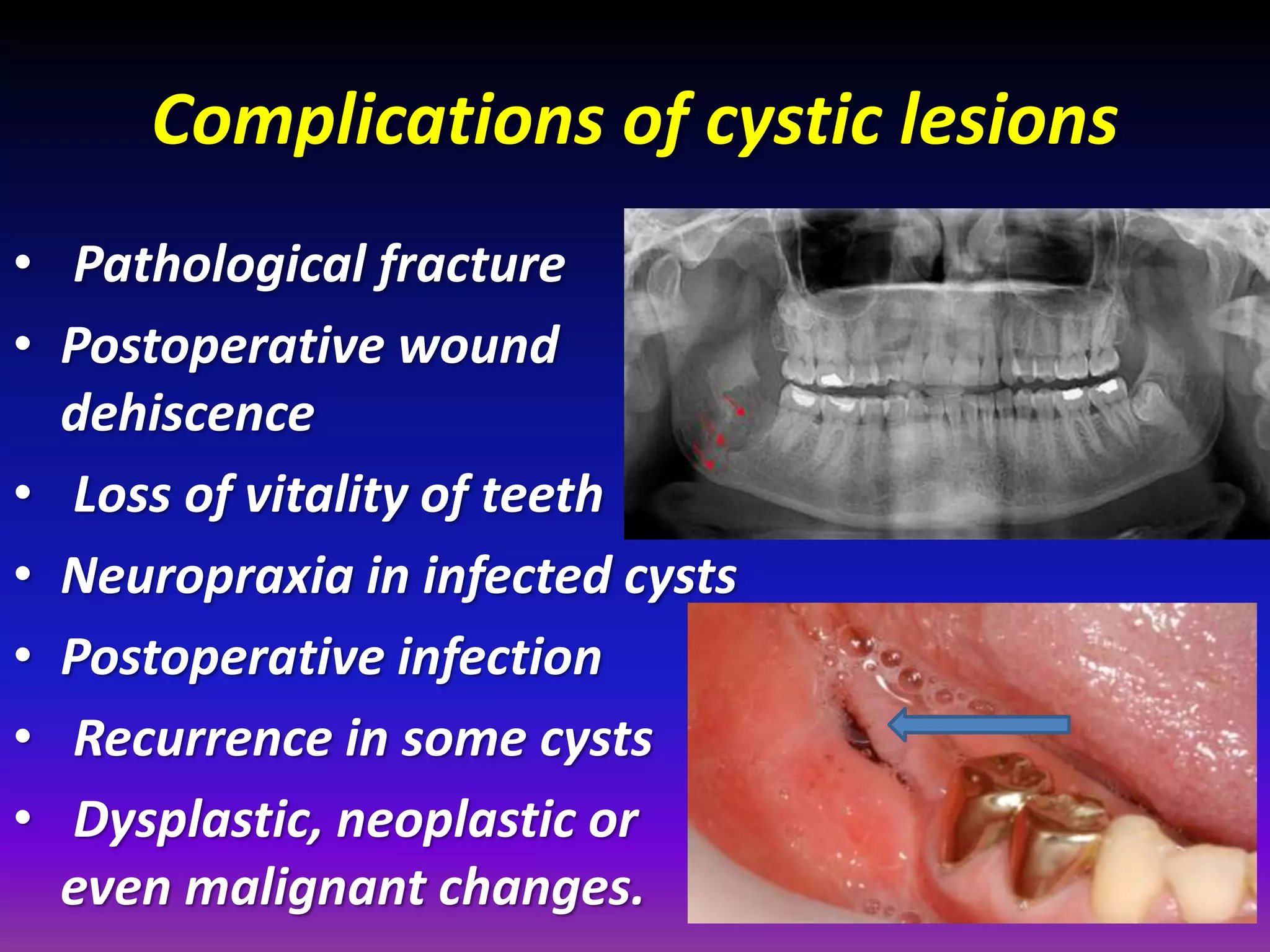 Cysts in orofacial region | PPSX