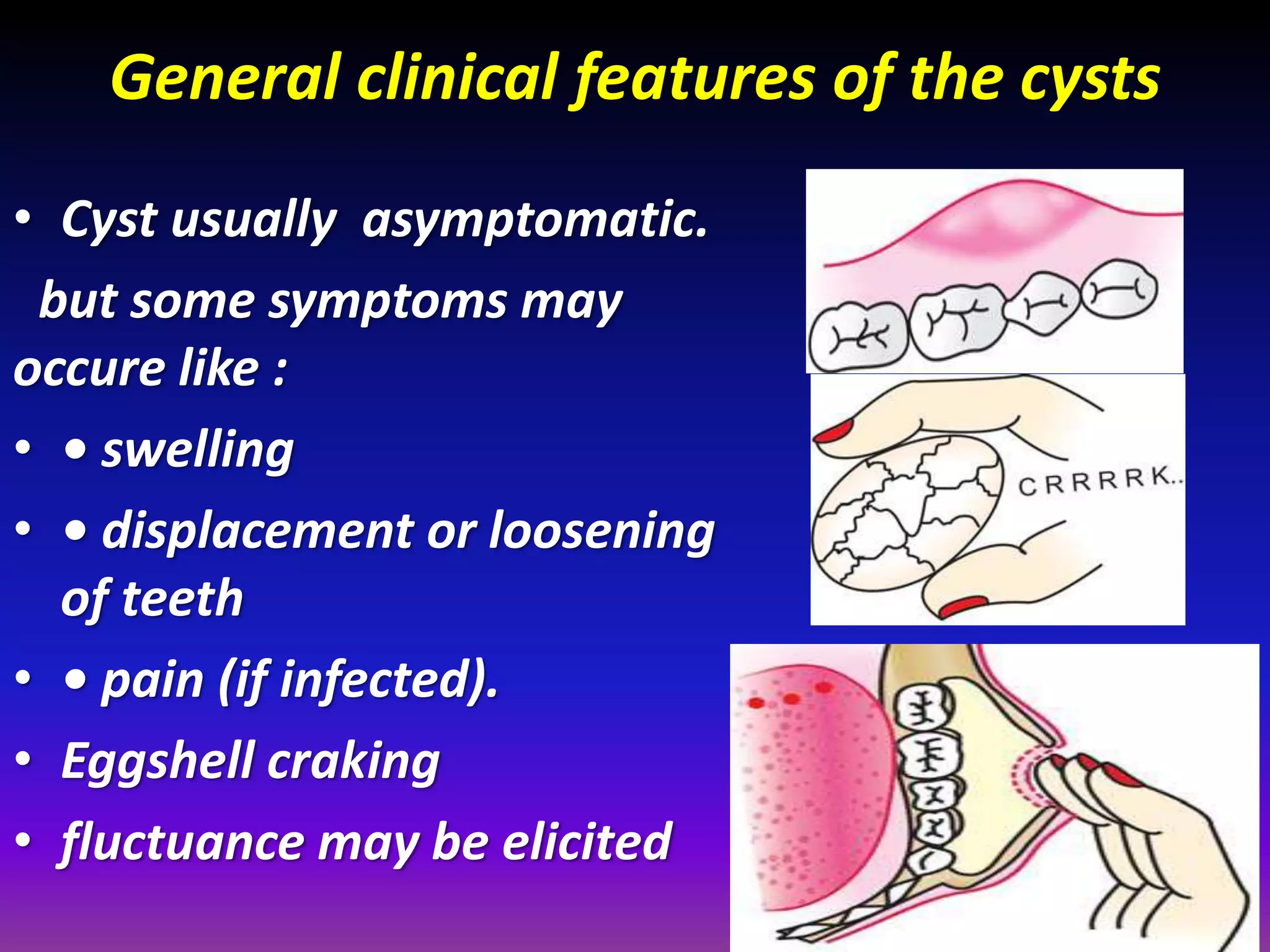 Cysts in orofacial region | PPSX