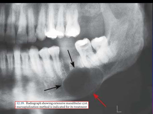Cysts in orofacial region | PPSX