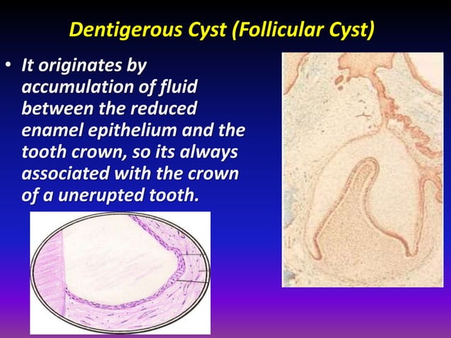 Cysts in orofacial region | PPSX