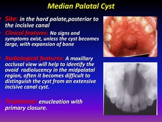 Cysts in orofacial region | PPSX