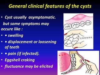 Cysts in orofacial region | PPSX