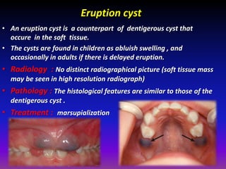 Eruption Cyst
