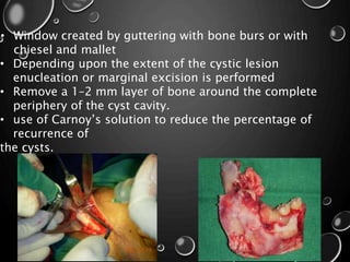 Cysts of jaw- management oral and maxillofacial surgery | PPTX