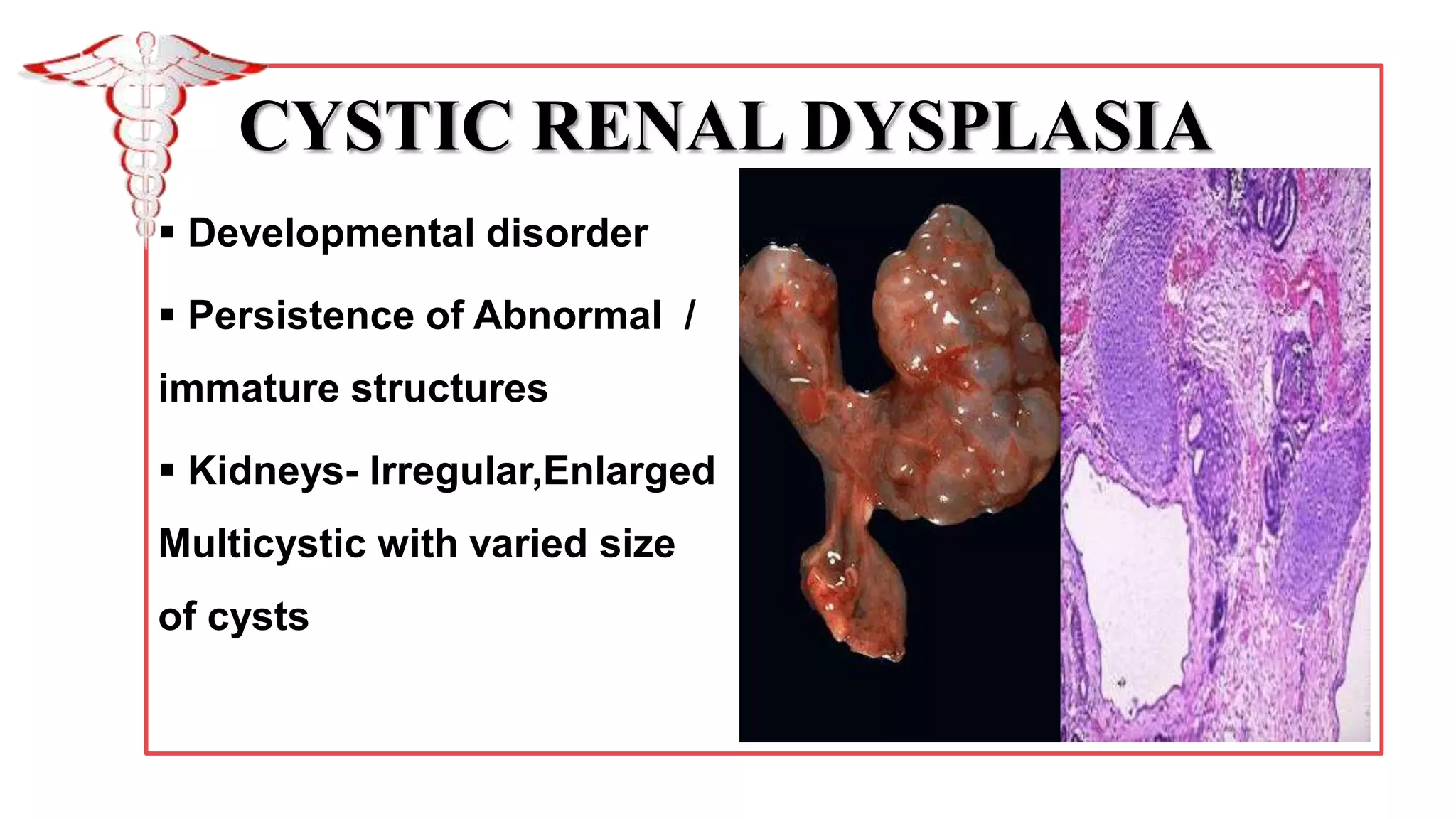 Cysts of kidney | PPTX