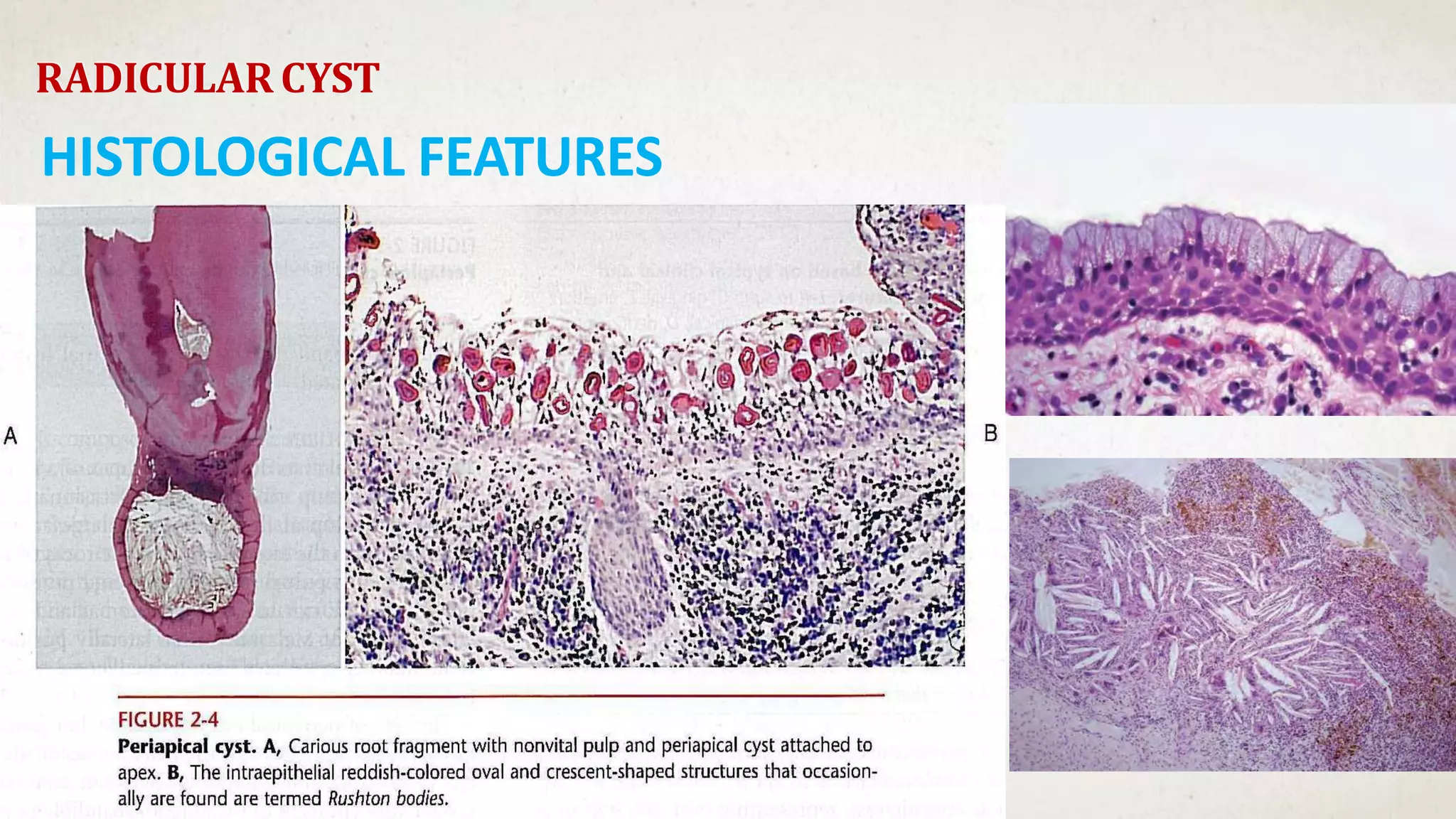 Cysts of oral and maxillofacial region by dr. maryam salman | PPTX