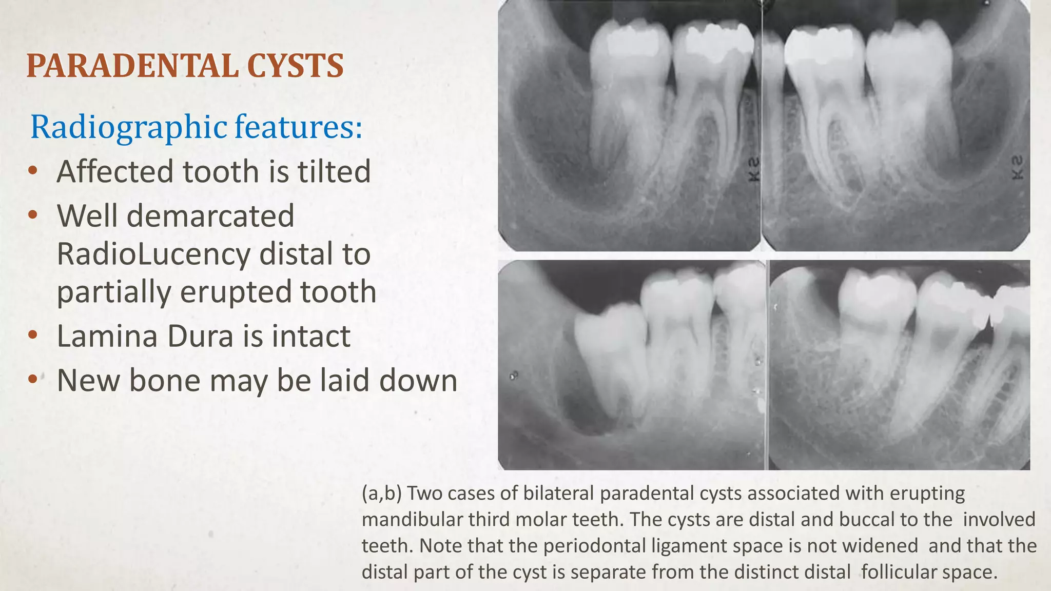 Cysts of oral and maxillofacial region by dr. maryam salman | PPTX