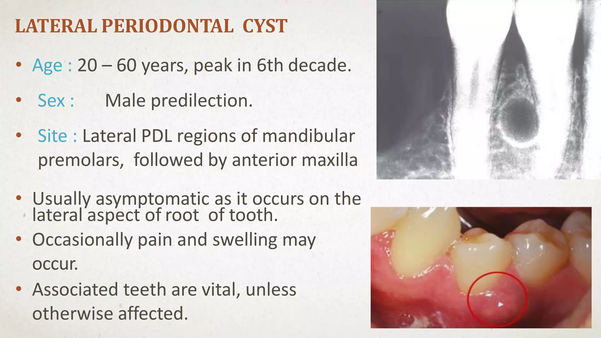 Cysts of oral and maxillofacial region by dr. maryam salman | PPTX