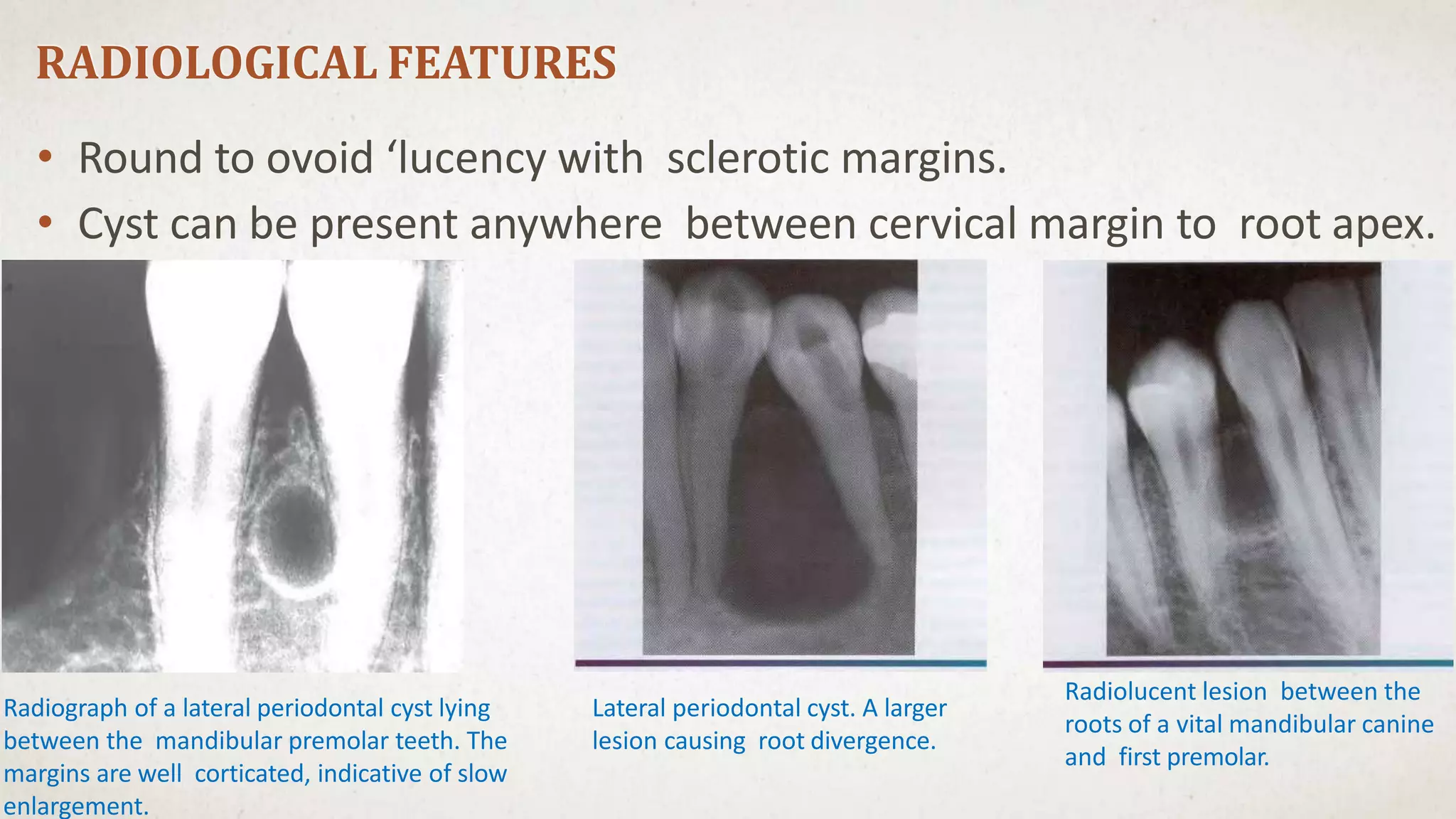 Cysts of oral and maxillofacial region by dr. maryam salman | PPTX