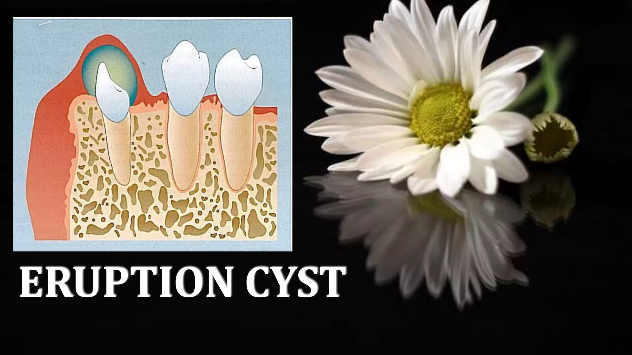 Cysts of oral and maxillofacial region by dr. maryam salman | PPTX