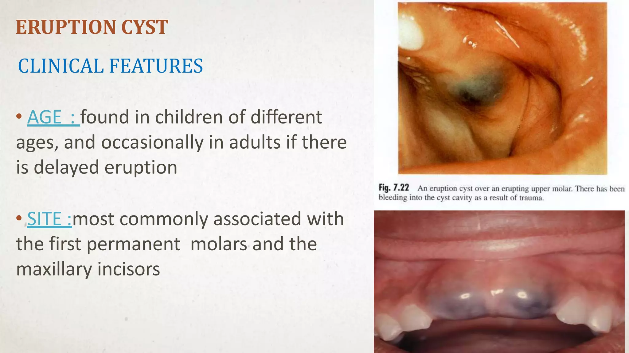 Cysts of oral and maxillofacial region by dr. maryam salman | PPTX