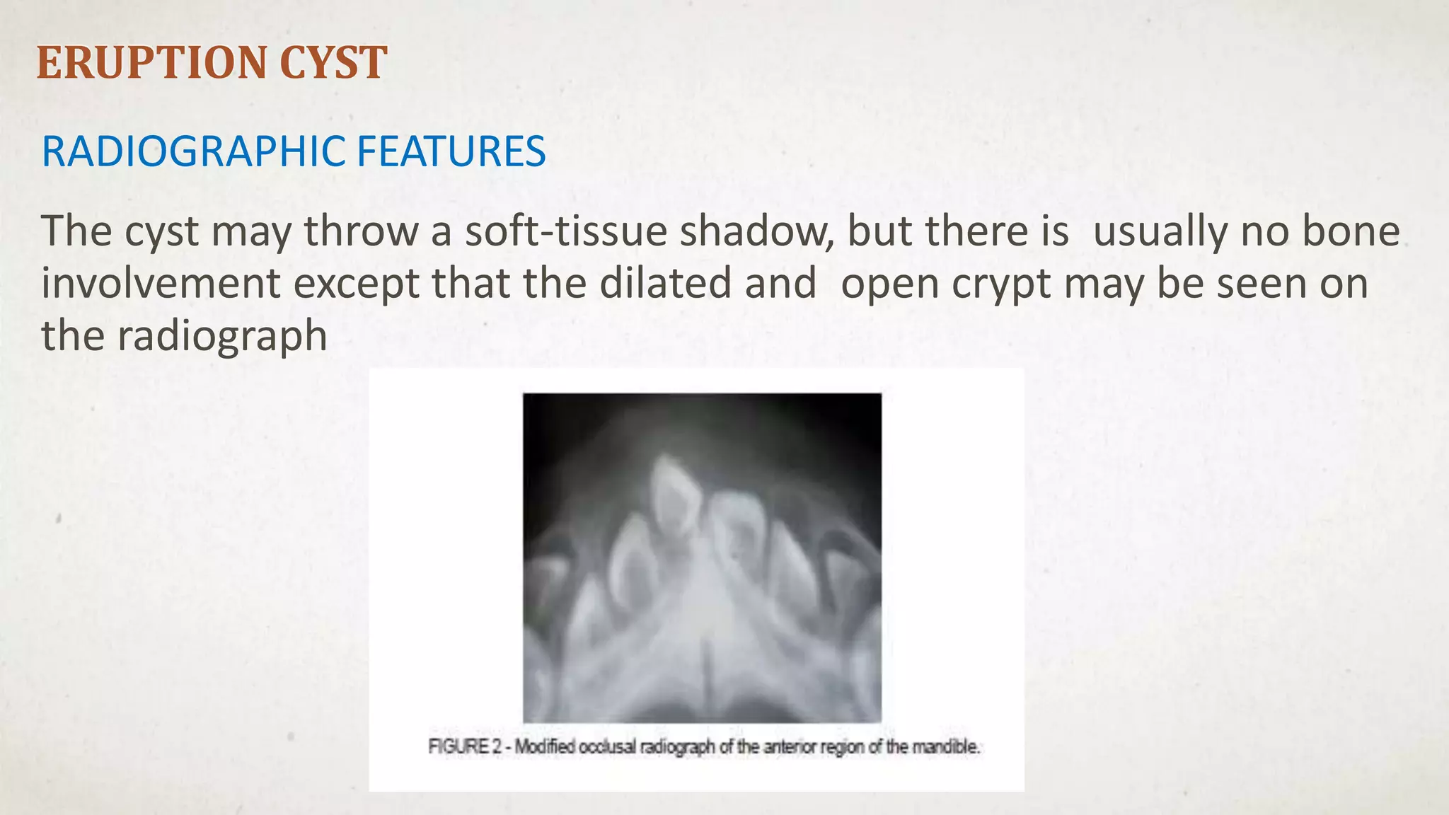 Cysts of oral and maxillofacial region by dr. maryam salman | PPTX