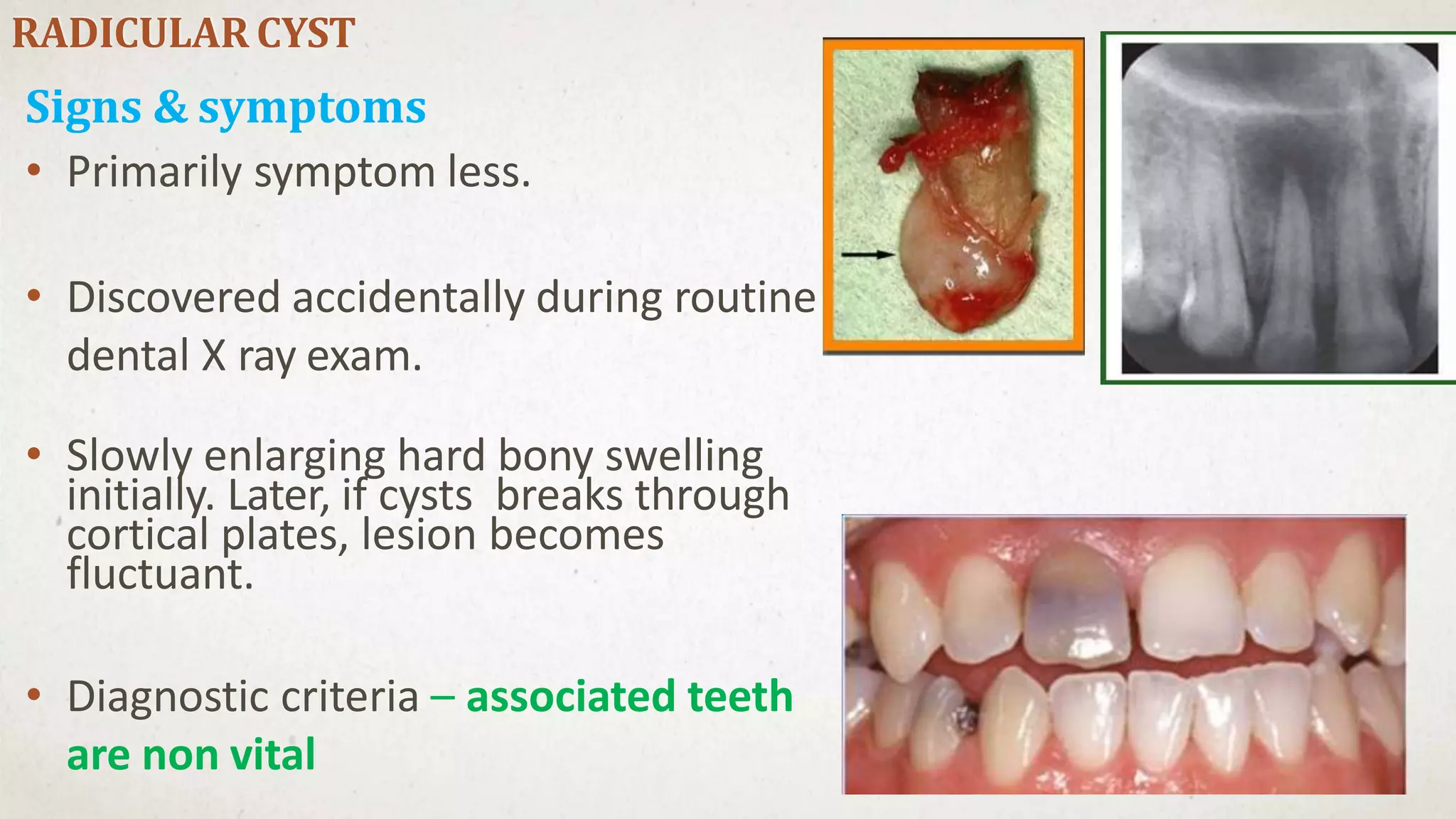 Cysts of oral and maxillofacial region by dr. maryam salman | PPTX