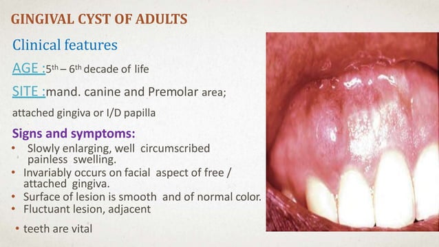 Cysts of oral and maxillofacial region by dr. maryam salman | PPTX