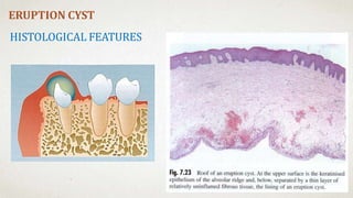 Eruption Cyst Histology